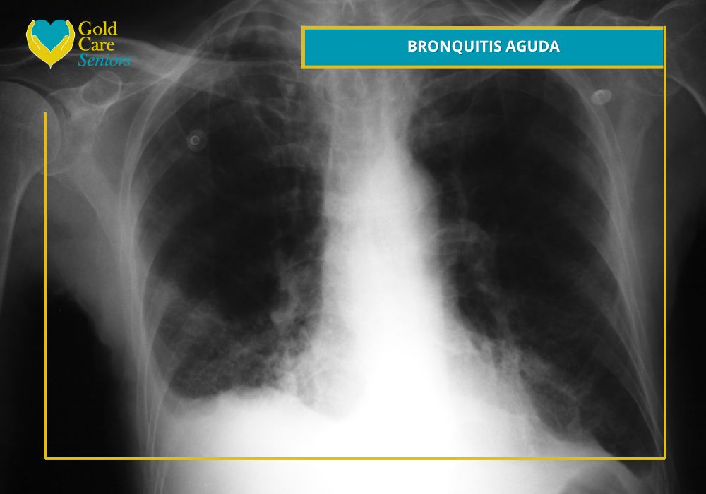 Bronquitis Aguda Pulmones